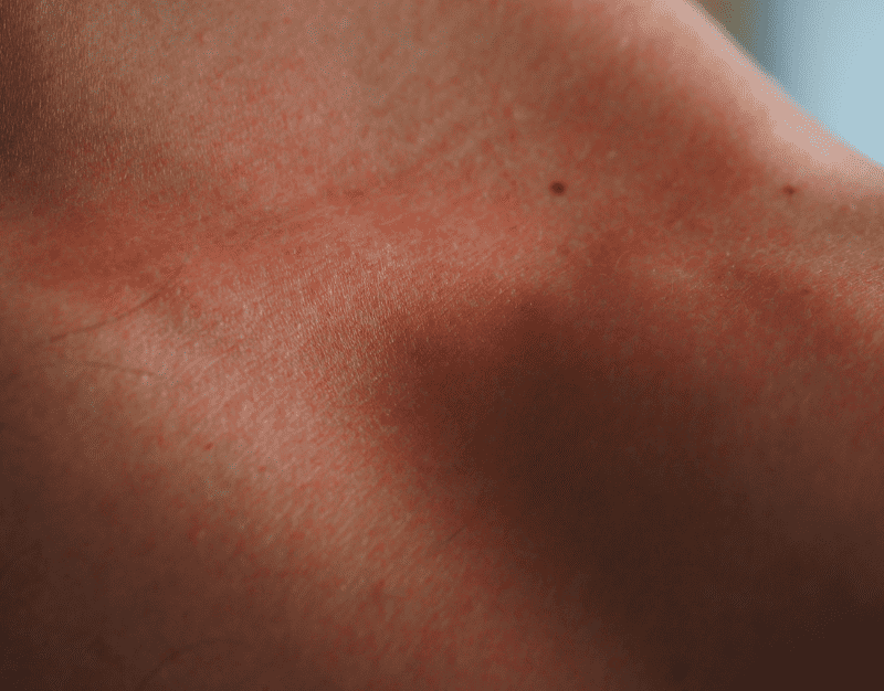 Detergent Allergy - EnviroKlenz